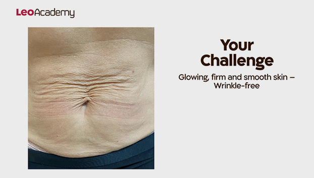 Leo Laser Skin Tightening Treatments in Golders Green, London | Lotus ...